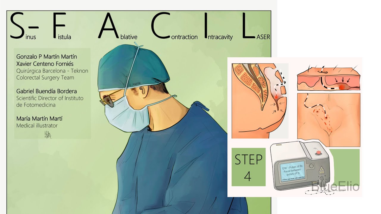 TECNICA "FACIL" CON LASER PARA EL SINUS PILONIDAL - YouTube