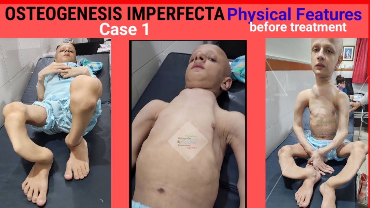 Osteogenesis Imperfecta CASE 1/Video 1/ Physical Examination BEFORE Treatment - YouTube