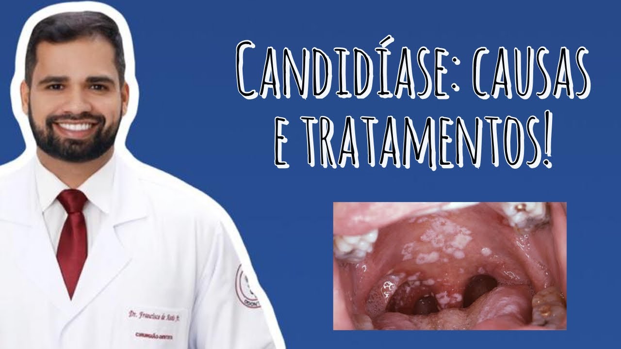 CANDIDÍASE na boca: Causas e tratamentos. É semelhante à que acontece ...