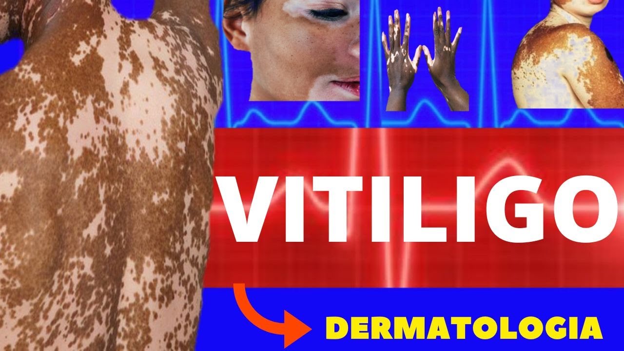 VITILIGO - CAUSA, SINTOMAS, DIAGNÓSTICO E TRATAMENTO - DERMATOLOGIA ...