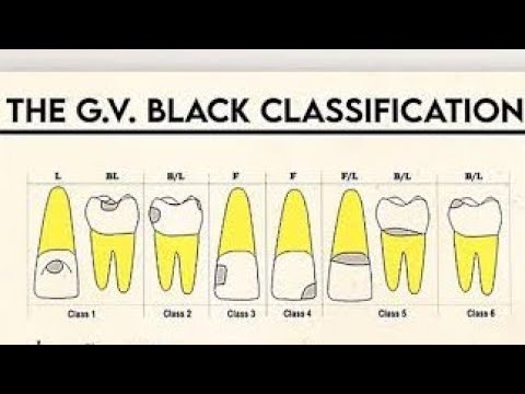 GV black's classification of cavity preparation/operative dentistry ...