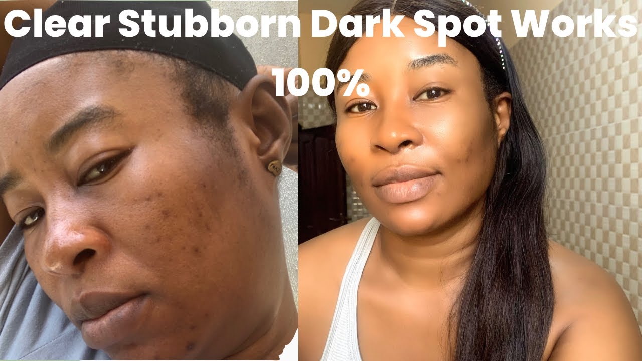 Clear Dark Spots, Dark Marks, Hyperpigmentation, sunburn Marks, Boost ...