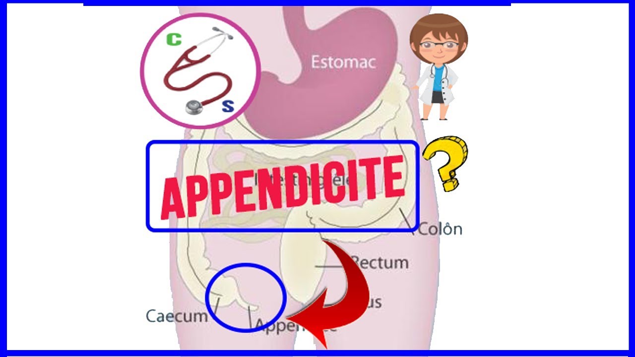 Appendicite-signe clinique, diagnostic , traitement - YouTube