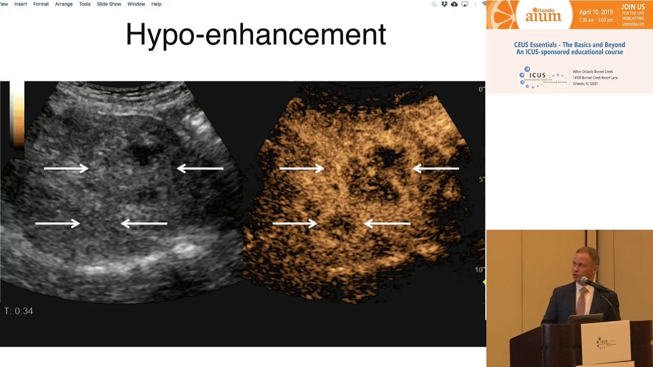 HCC Diagnosis and LI-RADS - YouTube