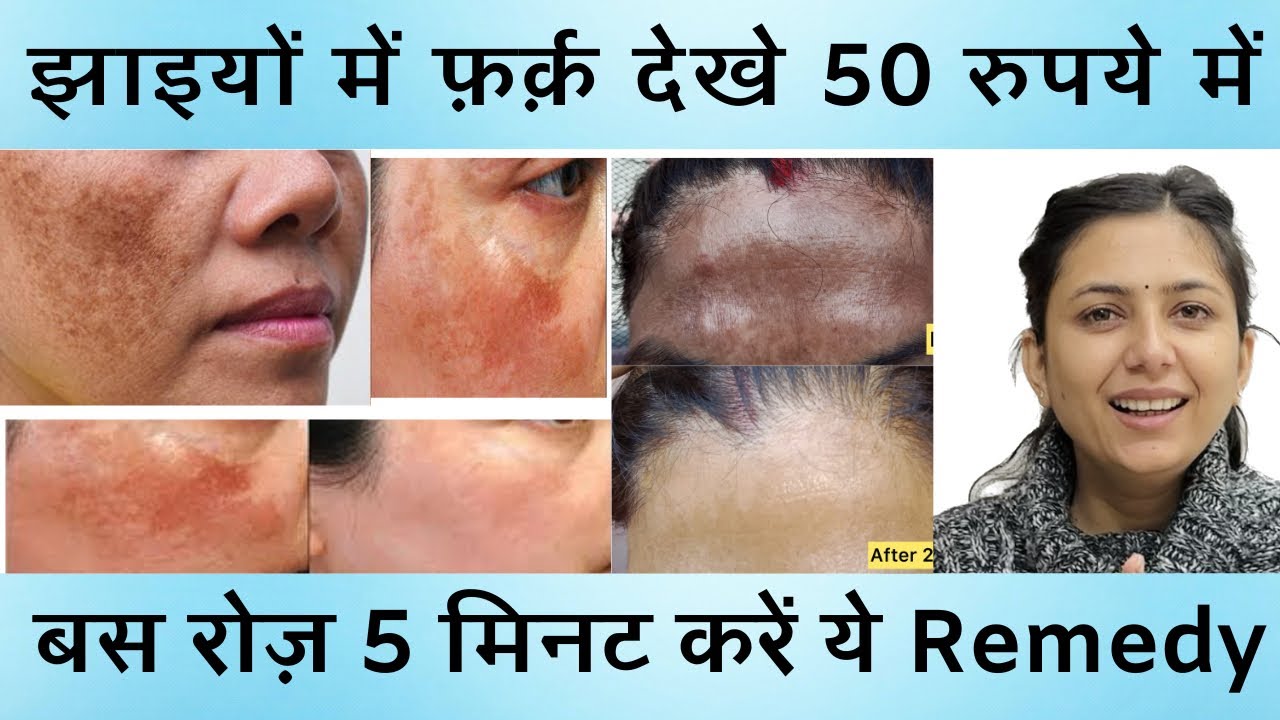 Jhaiyo ko Ghar Par Theek Kare | How to cure Jhaiya Pigmentation Melasma ...
