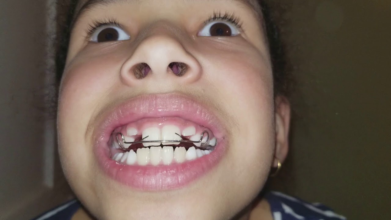 I got a retainer - YouTube