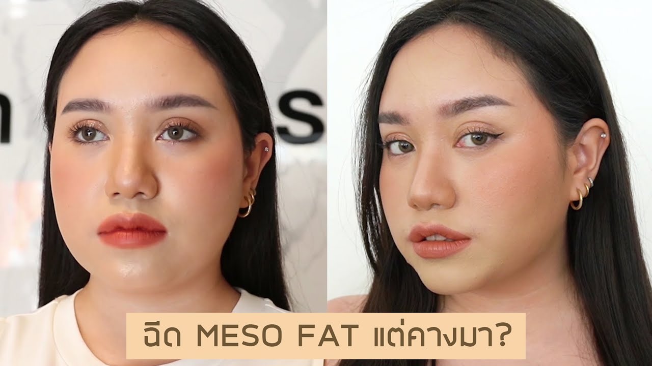 ฉีด meso fat (อีกแล้ว😂) ลดแก้ม ลดเหนียง แต่คางดันมา!! | LADY FRIDAY - YouTube