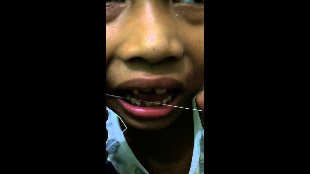 Tooth pulled out at home - YouTube