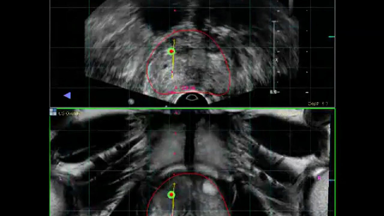 Images From TransRectal Prostate Biopsy | Urology Videos | - YouTube
