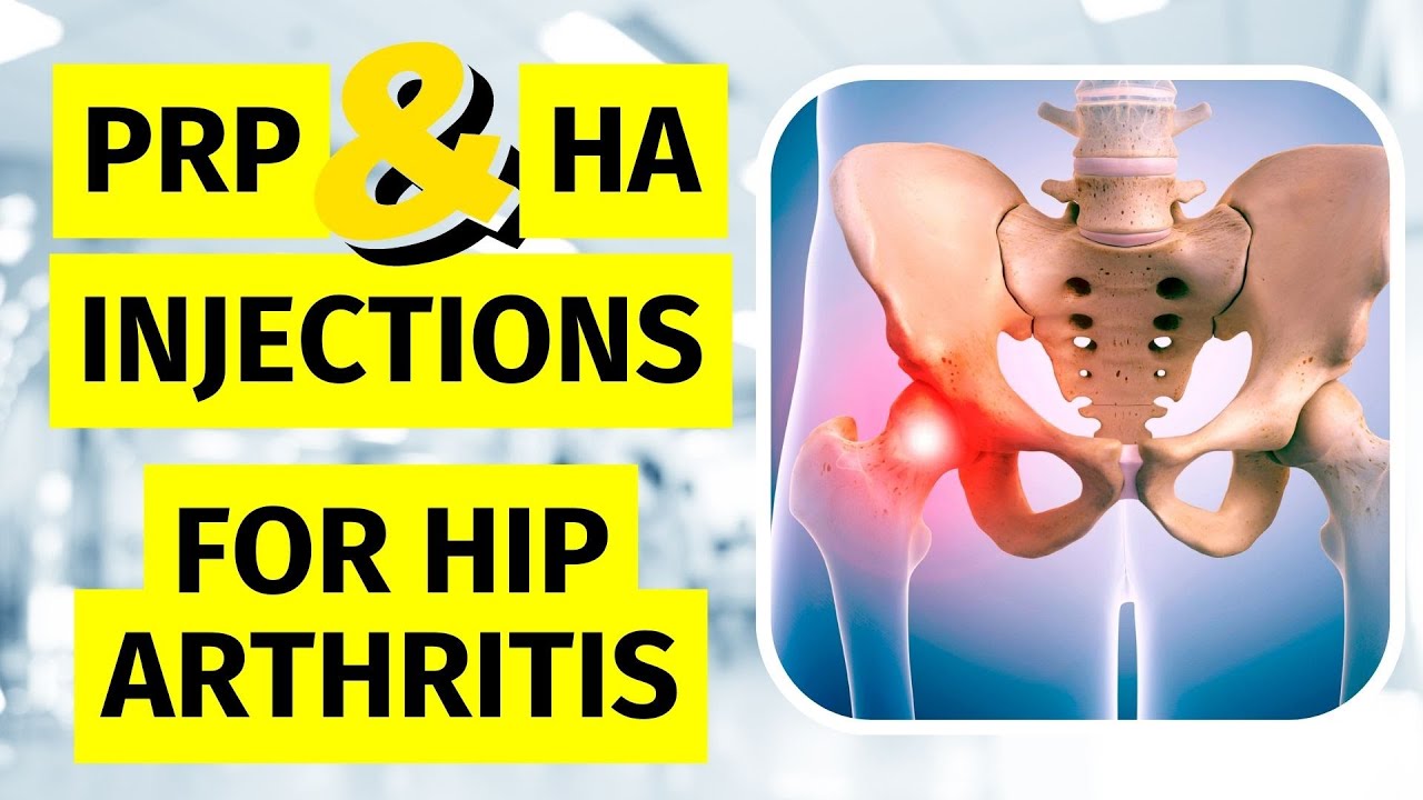 Hyaluronic Acid & Platelet Rich Plasma Injection for Hip Arthritis ...