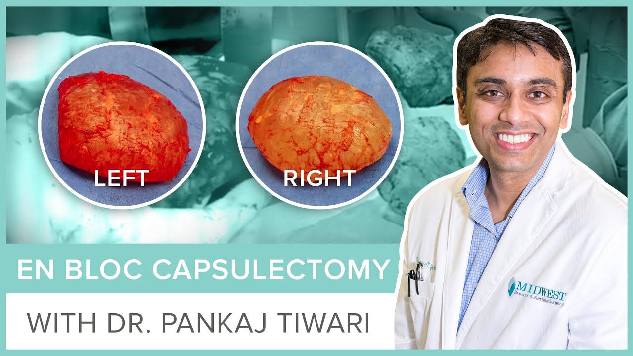En Bloc Capsulectomy with Dr. Pankaj Tiwari | Midwest Breast ...