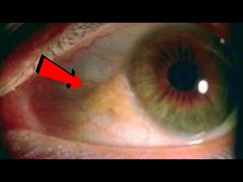 Gözlərdə SARI NÖQTƏ xəstəliyi nədir?