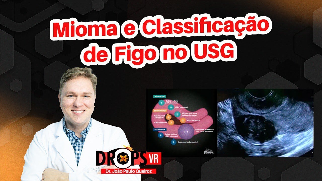 APRENDA RECONHECER E CLASSIFICAR OS MIOMAS I VOC RADIOLOGISTA YouTube APRENDA RECONHECER E CLASSIFICAR OS MIOMAS I VOC RADIOLOGISTA YouTube