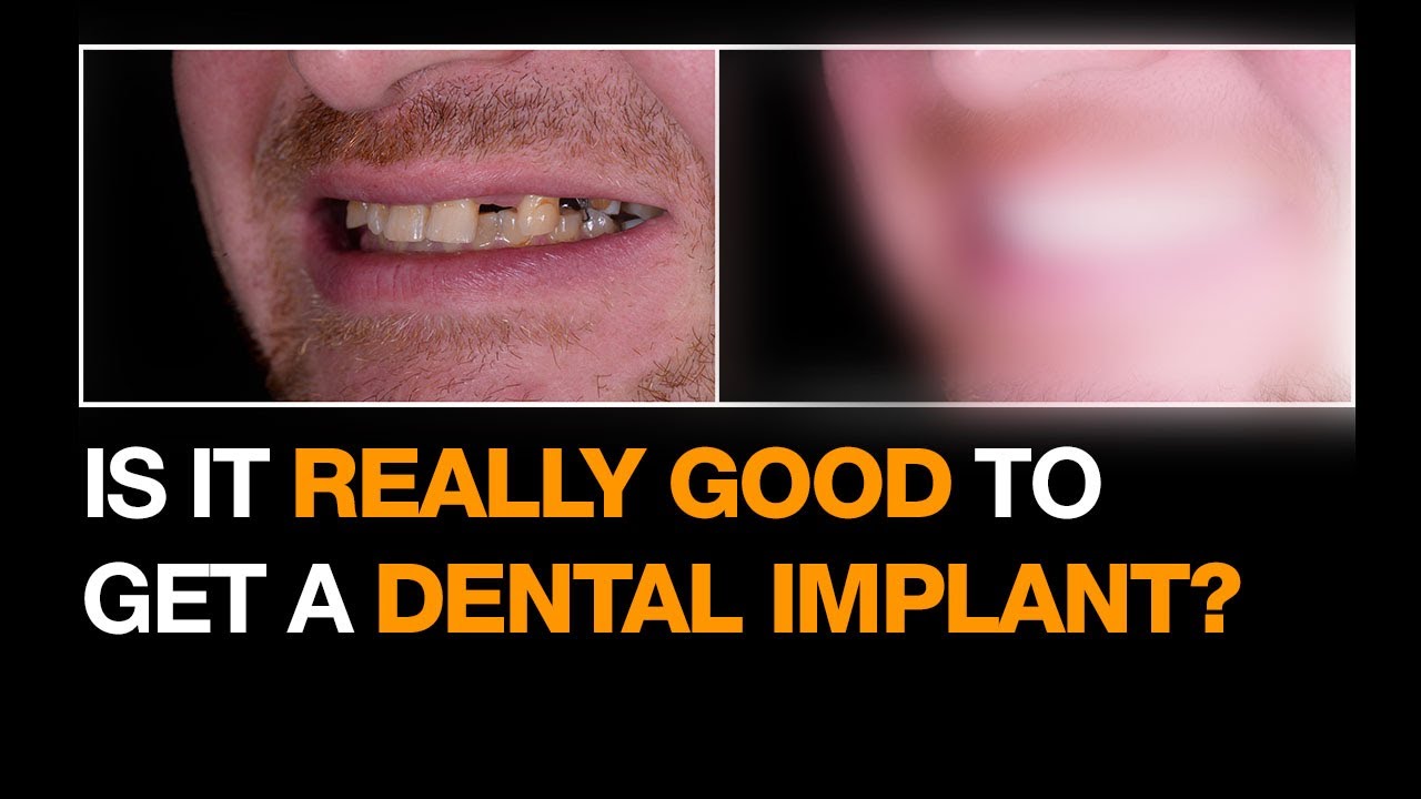 Titanium Implants Side Effects