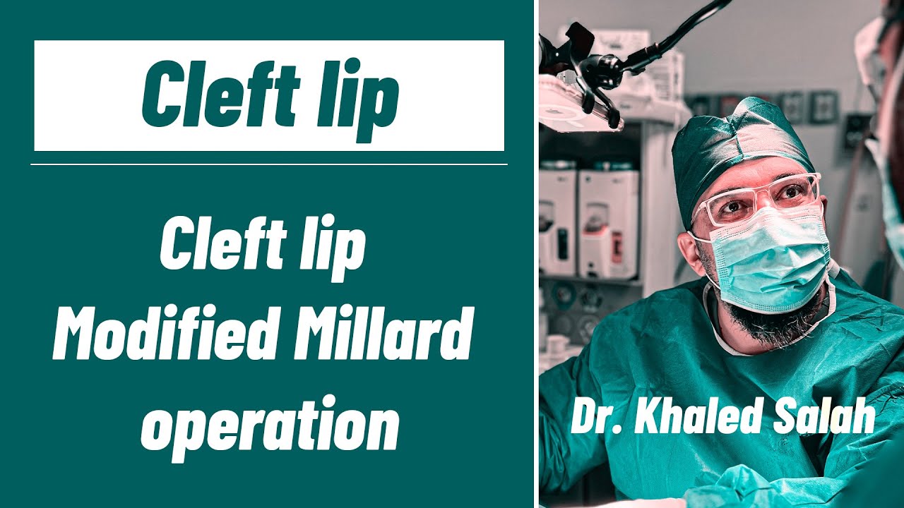 Cleft lip Modified Millard operation - YouTube