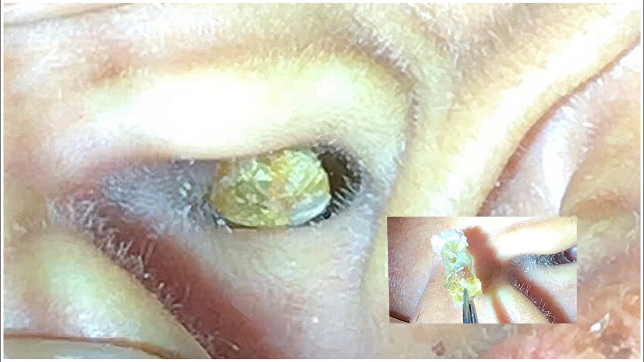 Earwax removing asmr , “ Em lấy ráy đã ngứa quá “ lấy ráy tai. Phần 52 ...