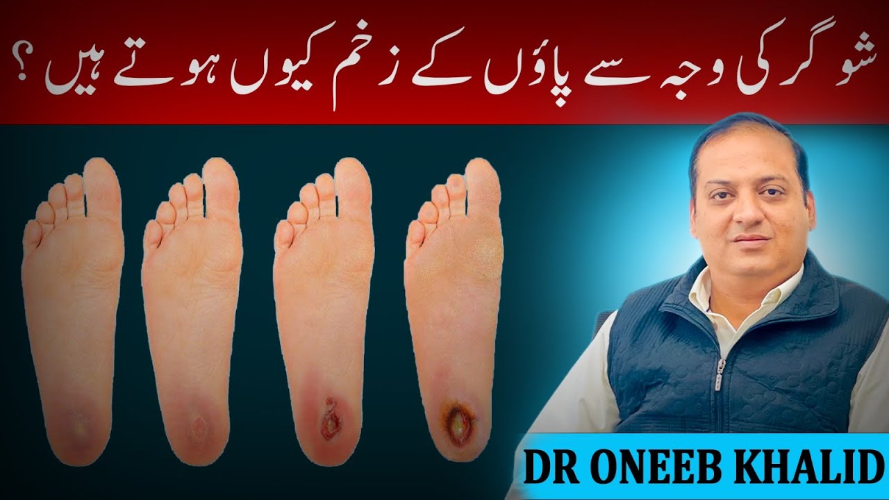 Diabetic foot kun banty hain BY DR. ONEEB KHALID - YouTube