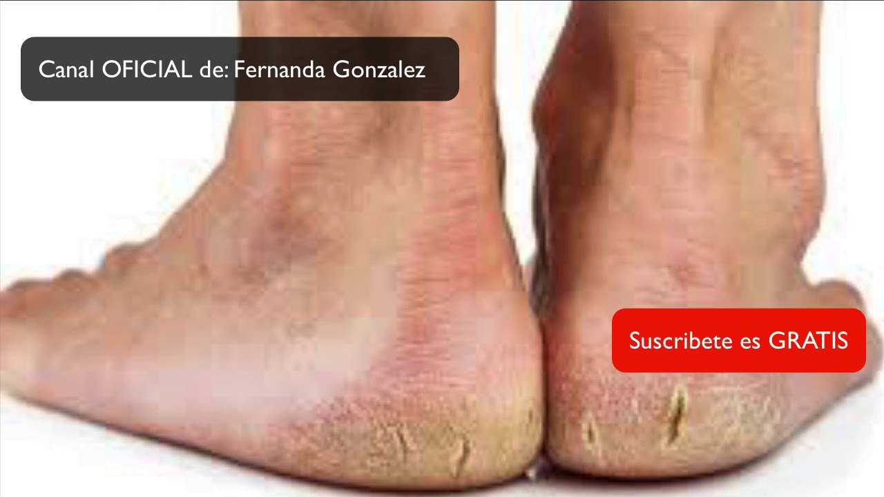 REMEDIO PARA TALONES PARTIDOS - Nunca mas volverás a tener TALONES ...