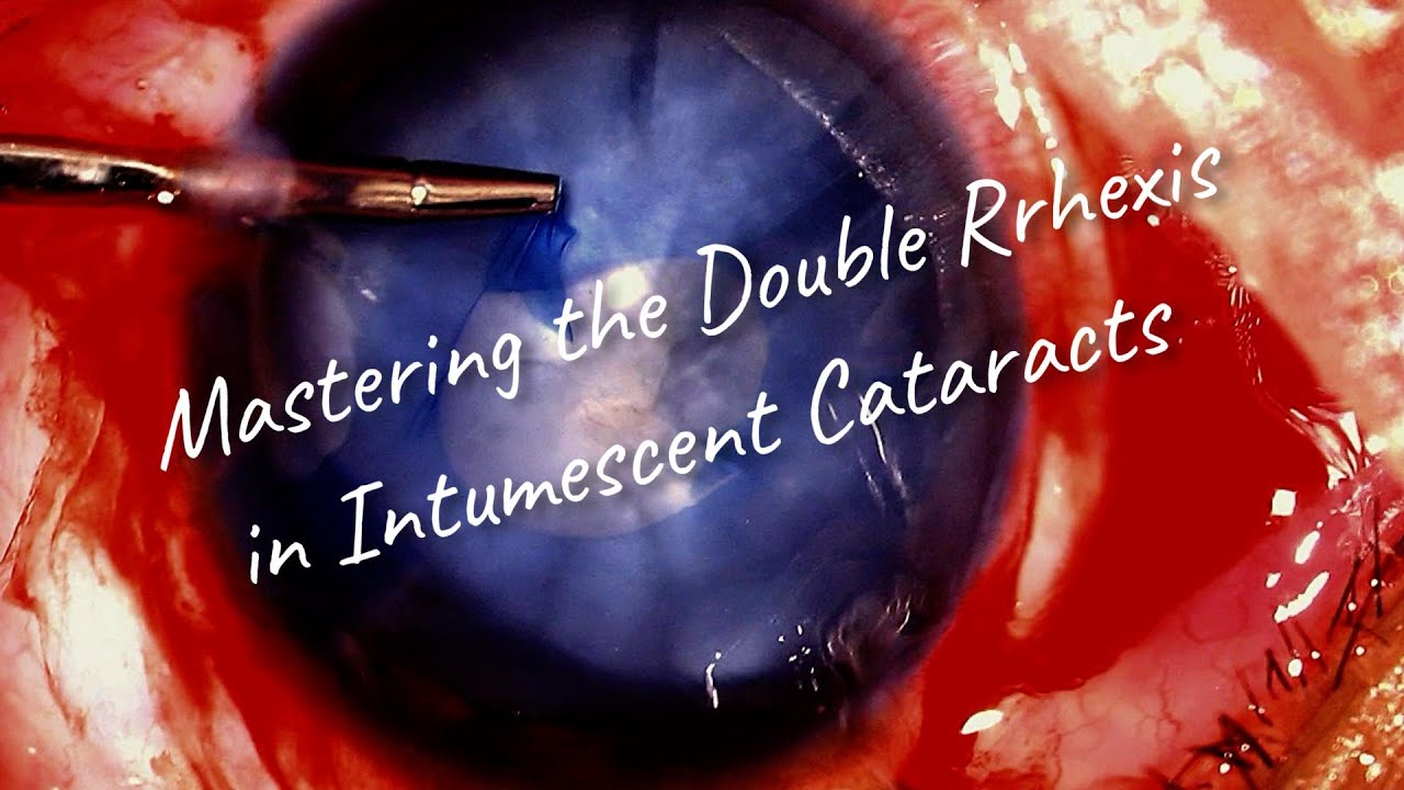 How to Master the Double Rhexis Technique for intumescent cataract - a ...
