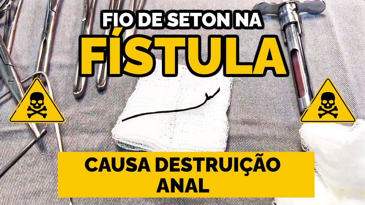 FIO DE SETON NA FÍSTULA CAUSA DESTRUIÇÃO ANAL- Dr. Paulo Branco ...