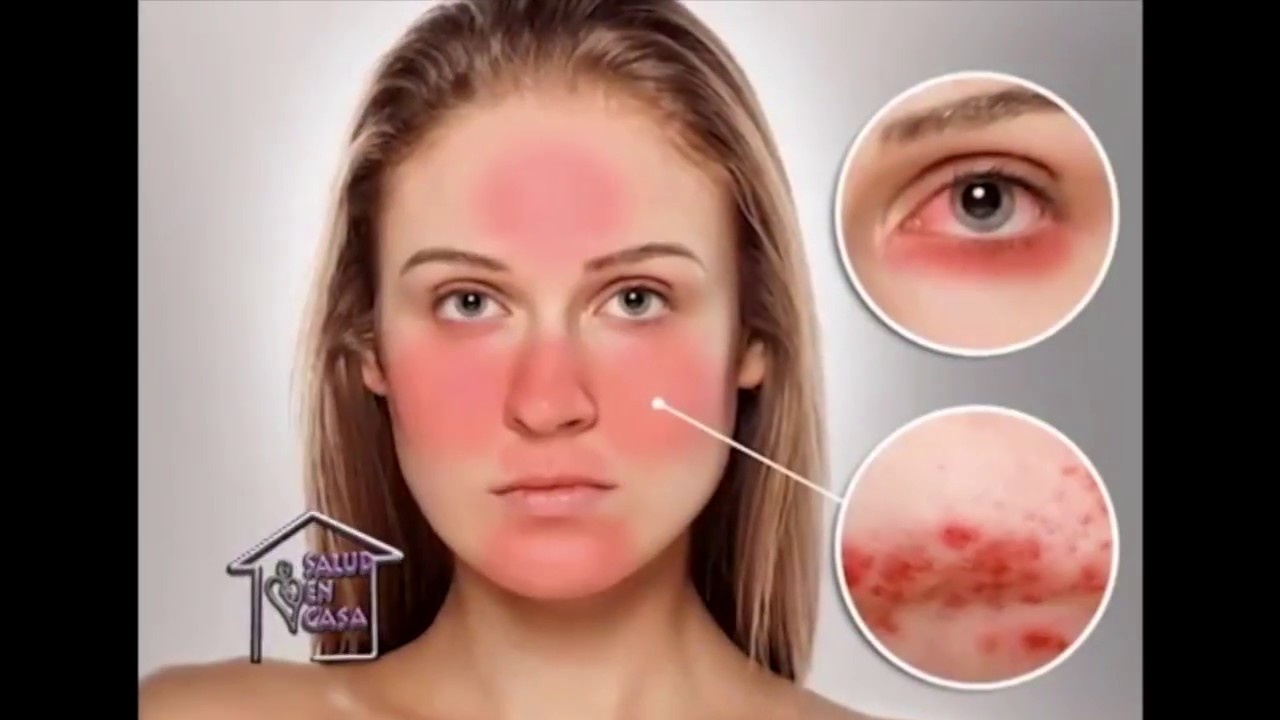 ROSÁCEA - PIEL ROJA Y DELICADA 🔥🔥🔥 - YouTube