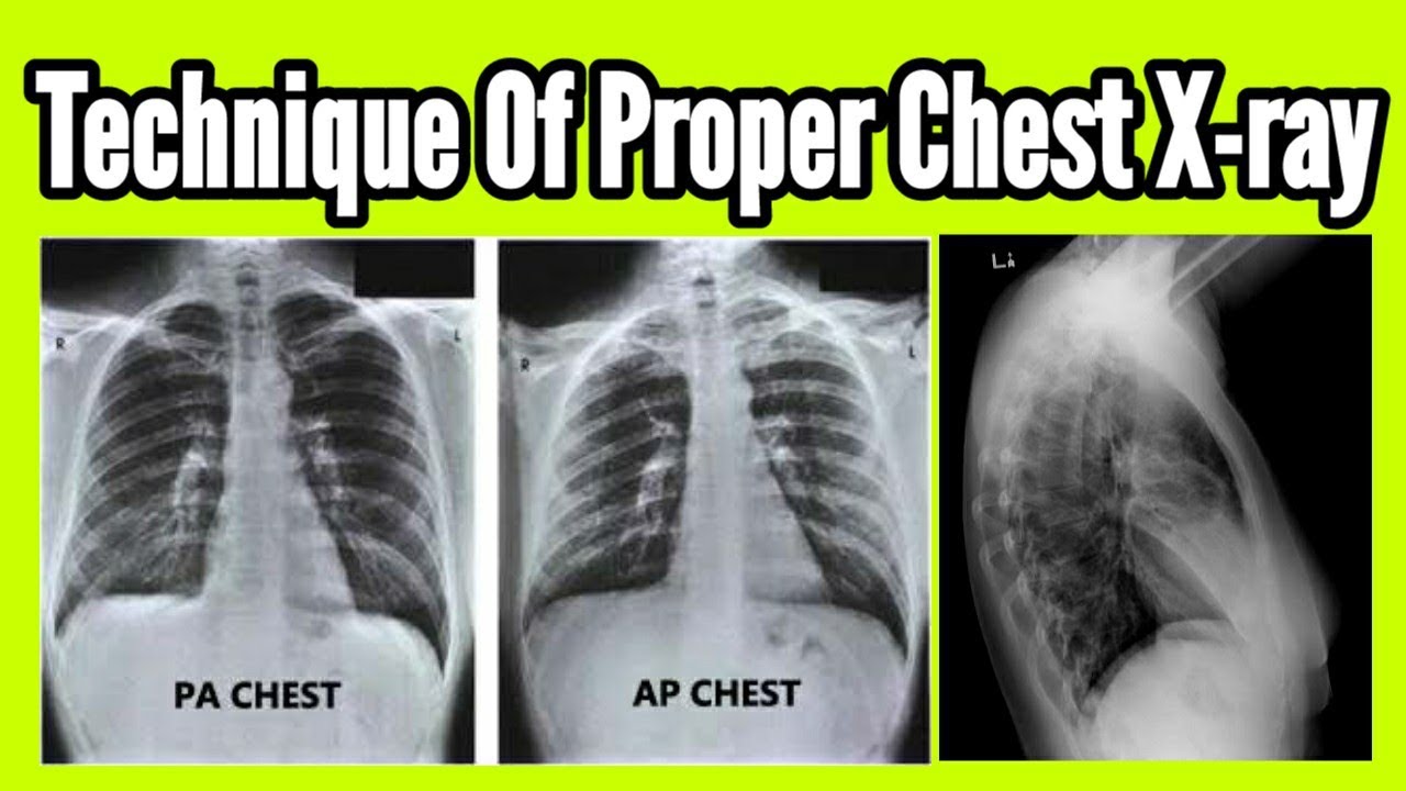 Technique of Proper Chest X-ray A/P, P/A, LATERAL VIEW - YouTube