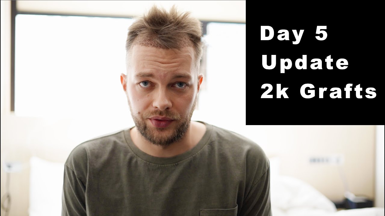 Day 5 Update Following Hair Transplant Procedure 2K Grafts at Motion ...