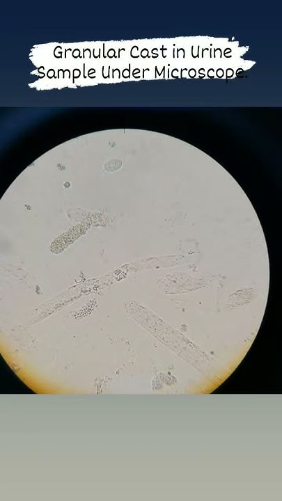 Granular Cast In Urine Sample Under Microscope Youtube