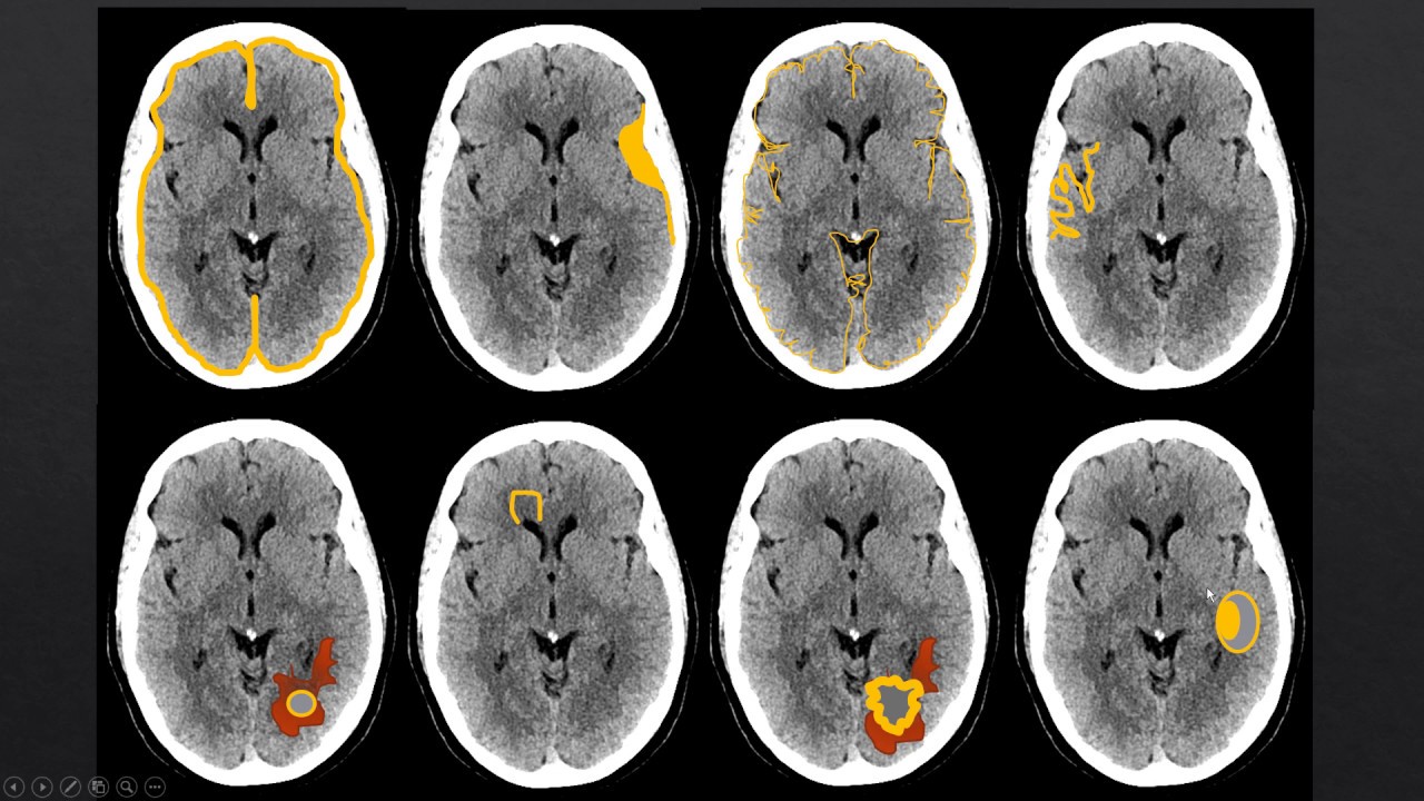 Enhancement Patterns in Neuroradiology - YouTube