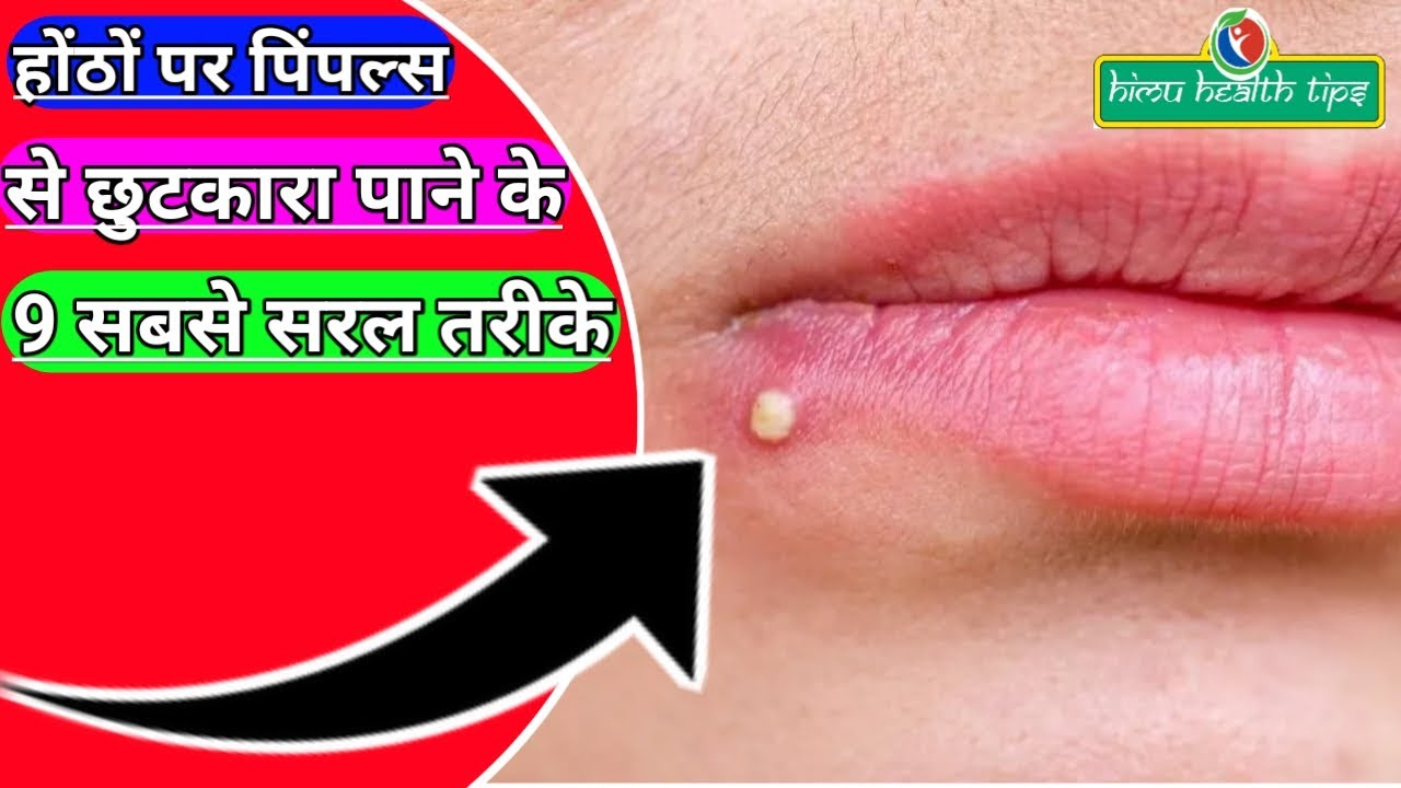 hotho par pimple ke gharelu upay | hotho par pimple hatane ka tarika ...