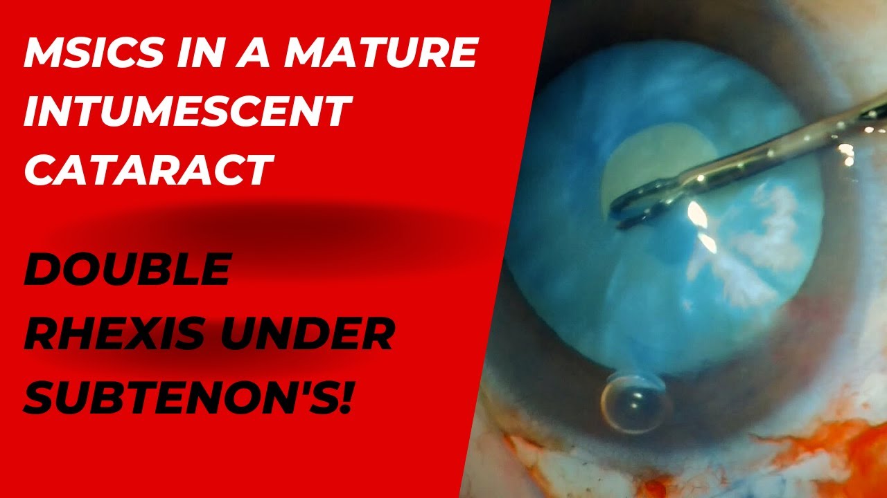 Case series 38. MSICS in mature intumescent cataract with compromised ...