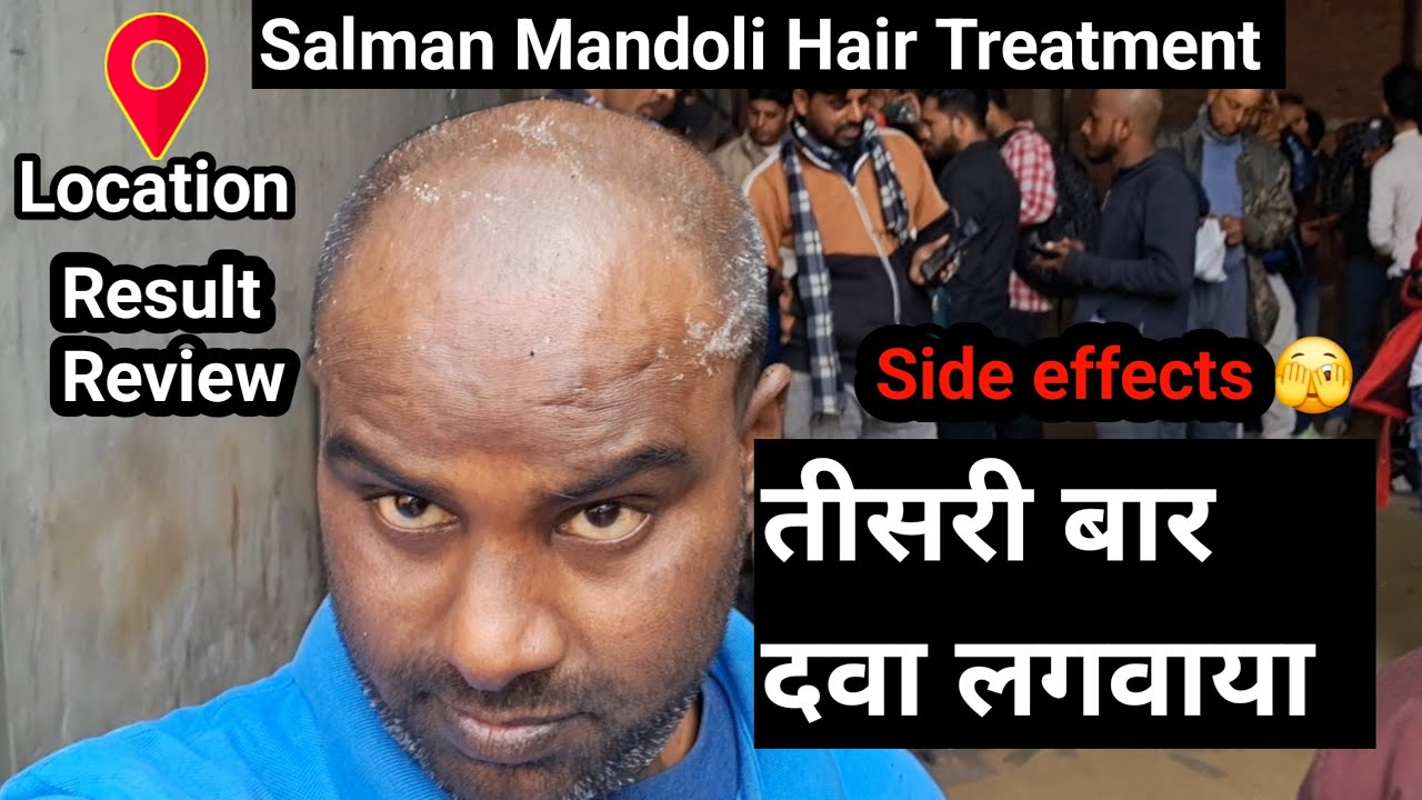 Salman Mandoli Hair Treatment Result | Salman mandoli location | Manoj ...