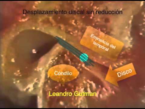 ATM Desplazamiento discal sin reducción - YouTube