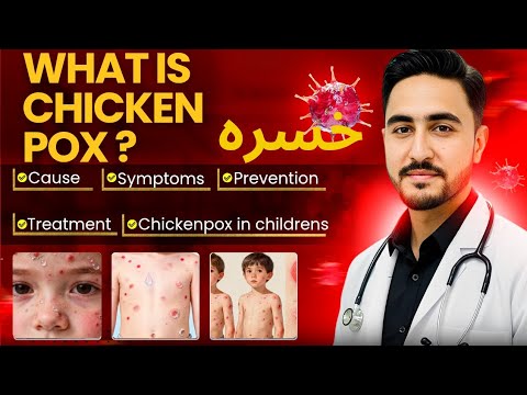 What is Chickenpox | Aur Iska Asaan Elaaj Kaise Mumkin Hai ? # ...