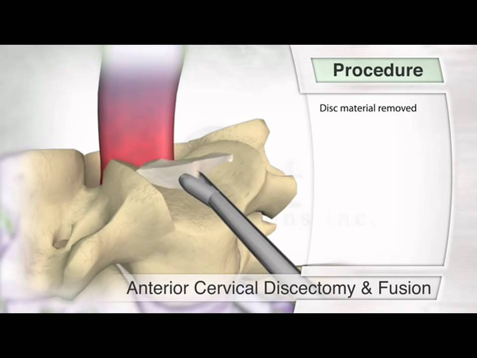 Anterior Cervical Fusion Procedure - YouTube