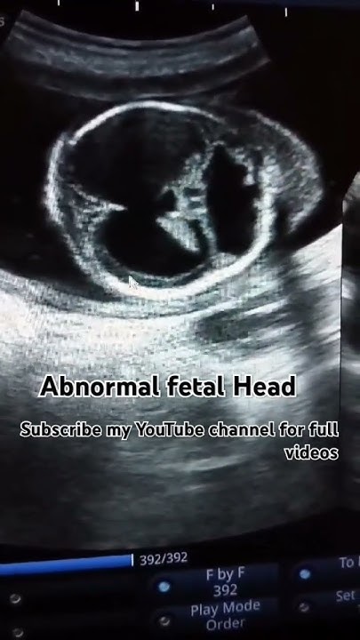Abnormal Fetal Head Anomaly Scan Youtube
