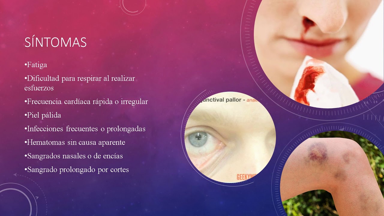 Monocitopenia en anemia aplásica - YouTube