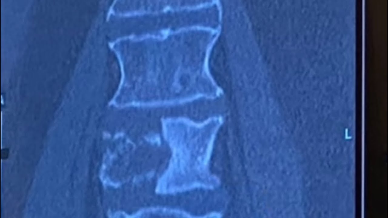 Good lord what did I watch?? Help me understand a strenuous bowel ...