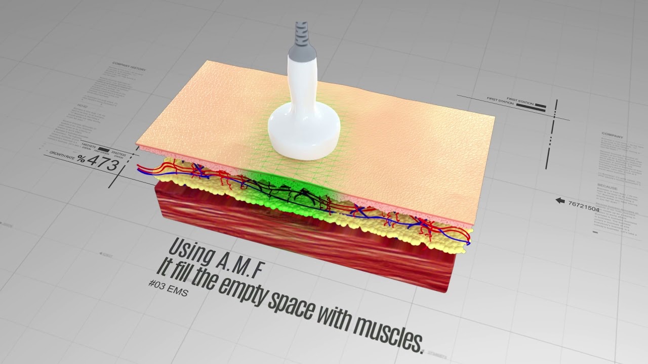 ProCare XP - YouTube