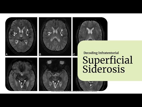 Decoding Superficial Siderosis - YouTube