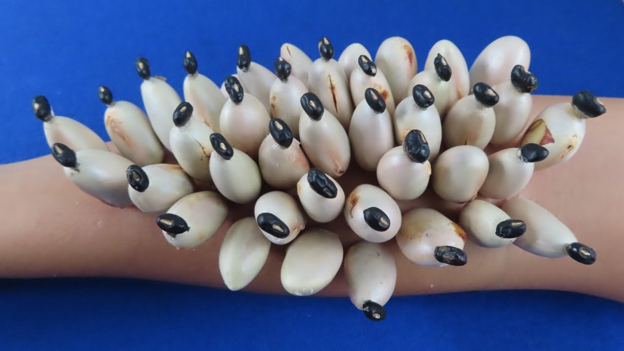 Wow Amazing giant ticks style removal from arm lady | Designed from ...