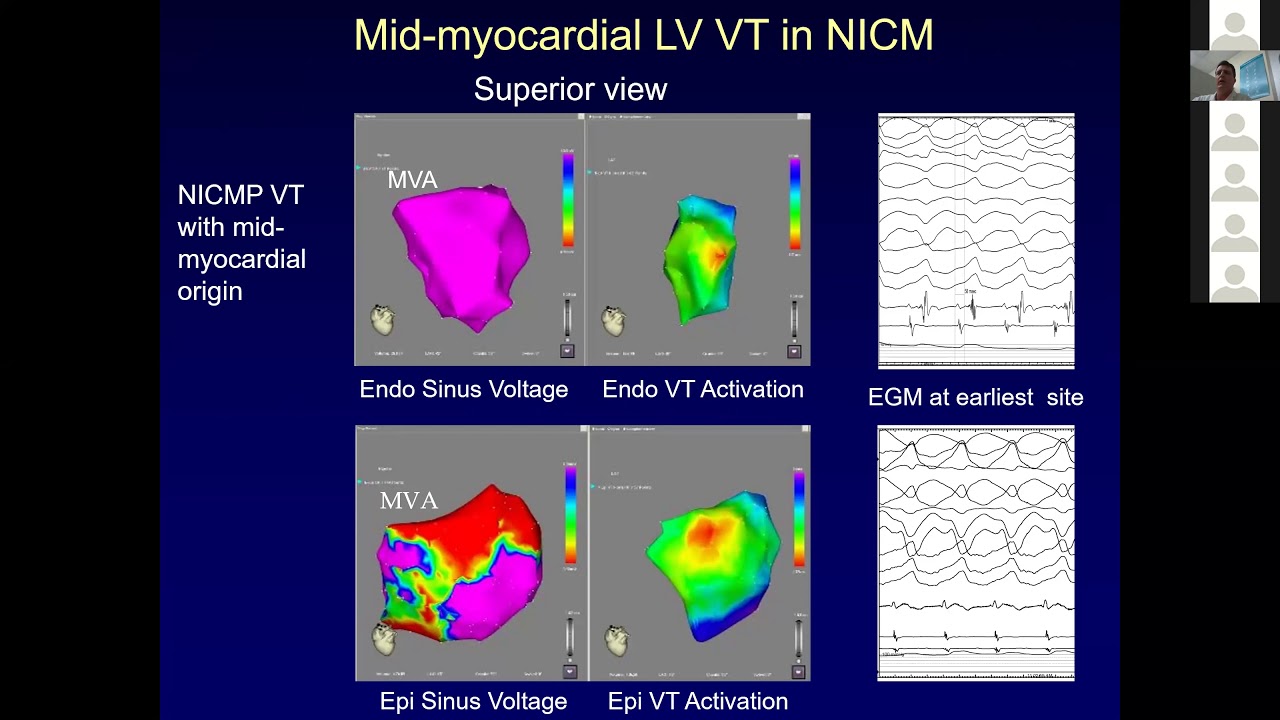 6 12 20 Winterfield Imaging and VT Ablation pt 1 - YouTube