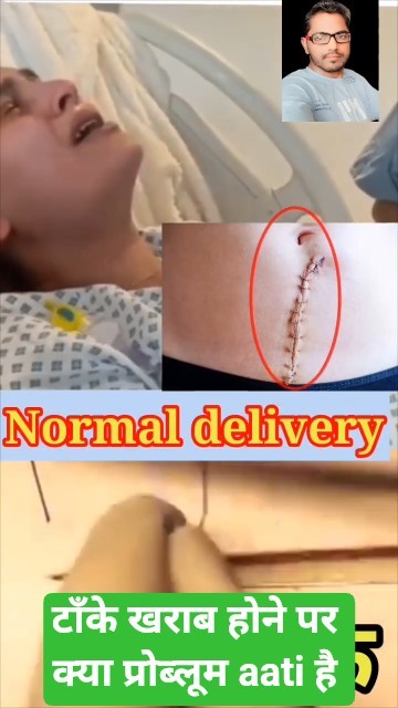 Normal Delivery aur C-Section me टांके कब लगते हैं? 👇#C-Section के बाद ...