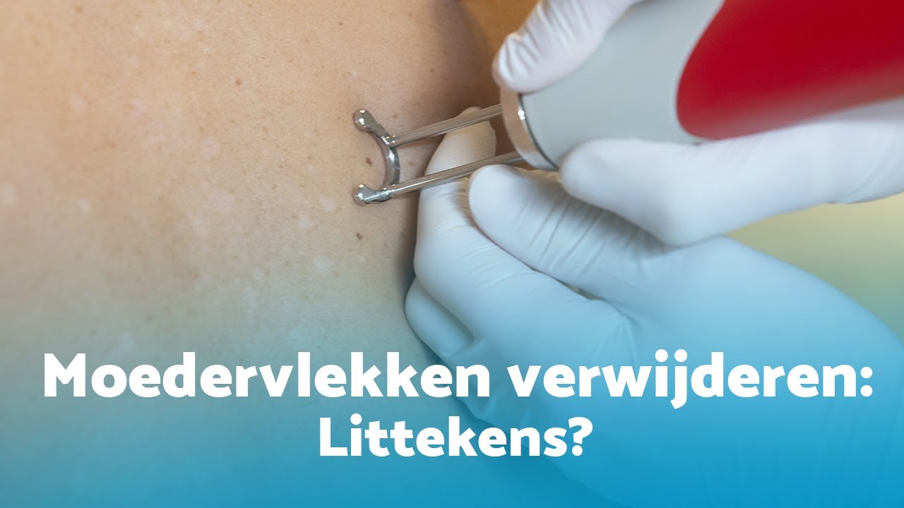Moedervlekken verwijderen; ontstaan er littekens vanwege de behandeling ...