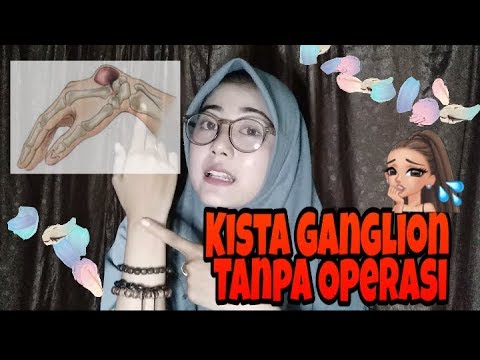 KISTA GANGLION tanpa OPERASI - YouTube