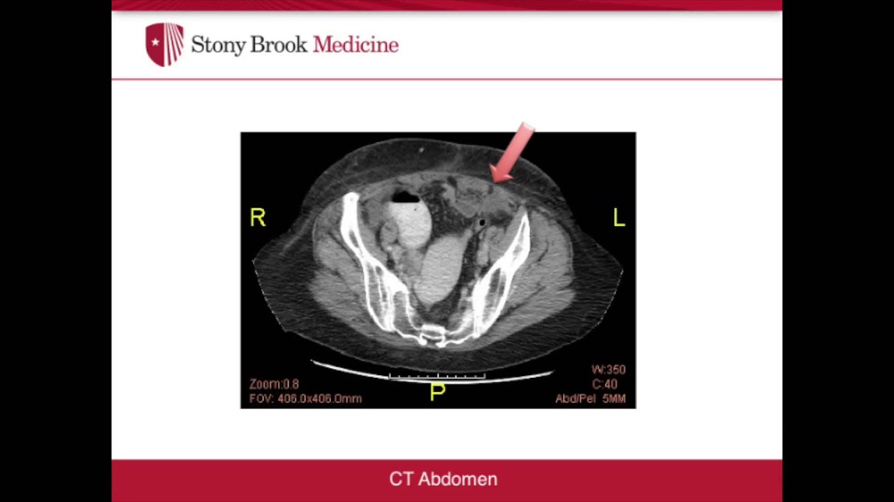 V019 SMALL BOWEL OBSTRUCTION AFTER BILATERAL TAPP INGUINAL HERNIA ...
