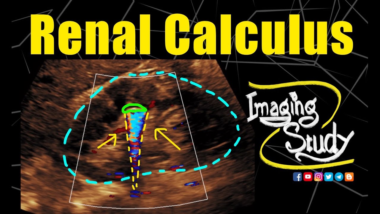 Renal Calculus || Nephrolithiasis || Twinkling Artifact || Ultrasound ...
