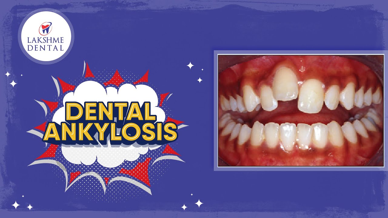 These 2 Facts about Dental Ankylosis might shock you 😲 #dentalwork # ...