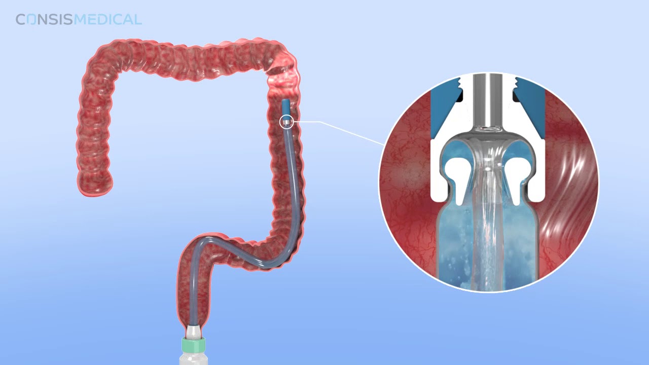 Consis Medical - by Napo3D - YouTube