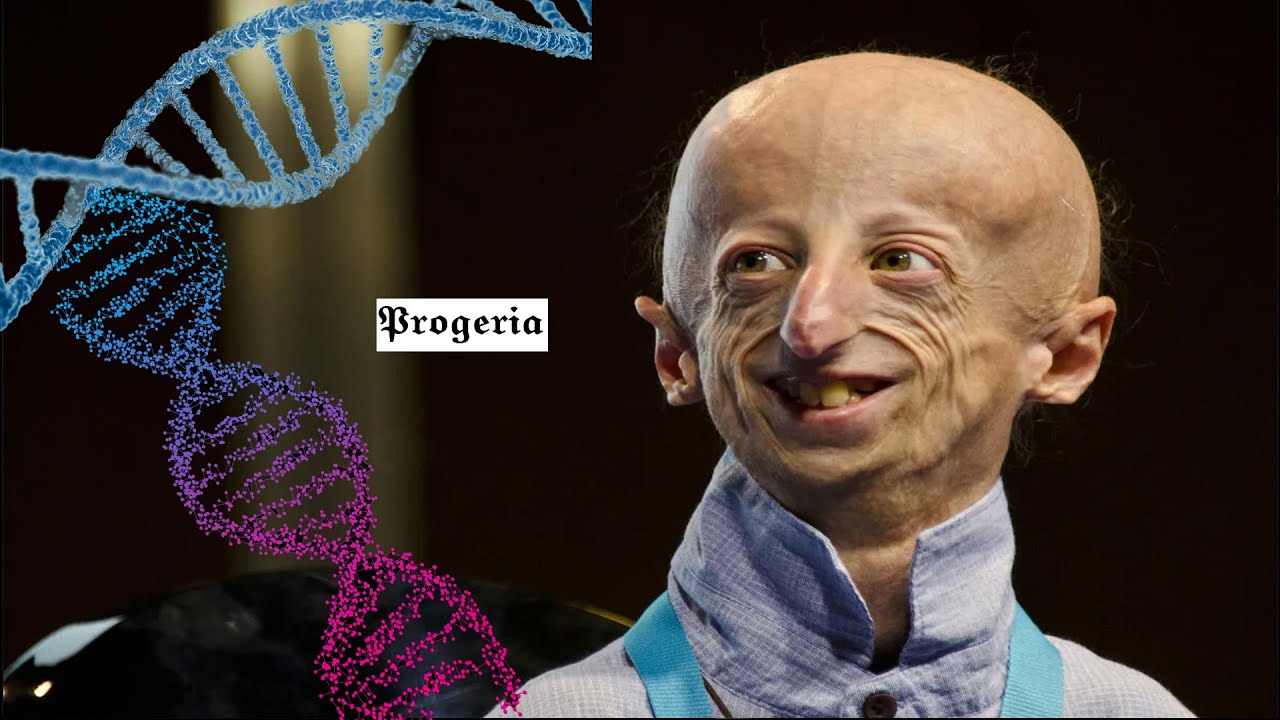 The TERRIFIC History of Progeria - YouTube